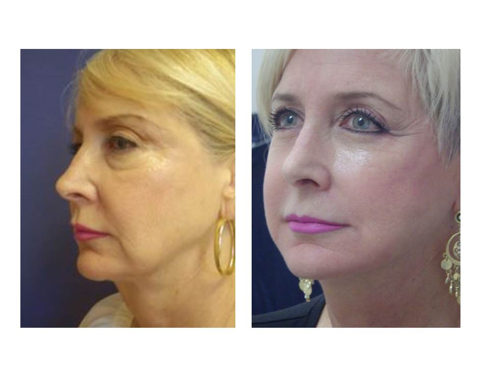 Face Lift | Advanced Specialty Care
